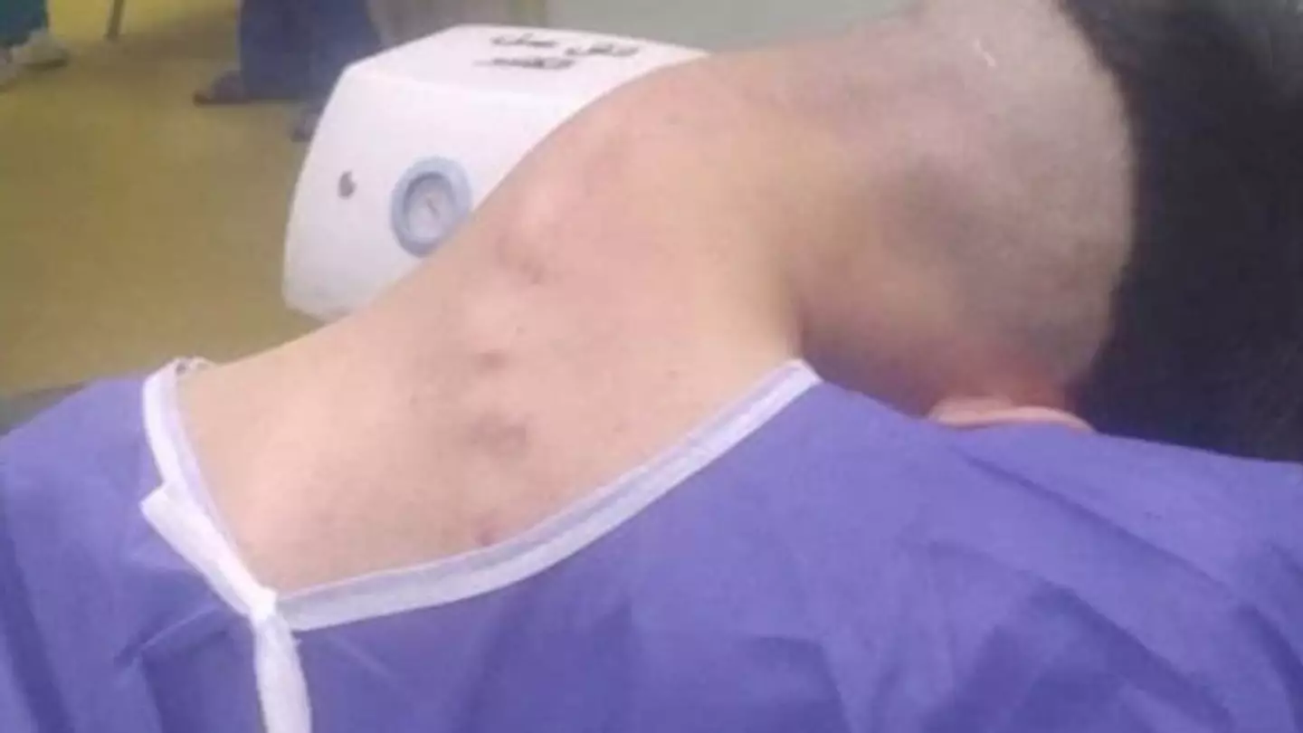 Man, 23, develops rare condition called ‘dropped head syndrome’ after ...